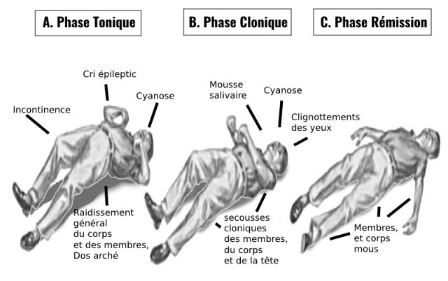 Premiers secours en cas de crises - Épilepsie Info Service